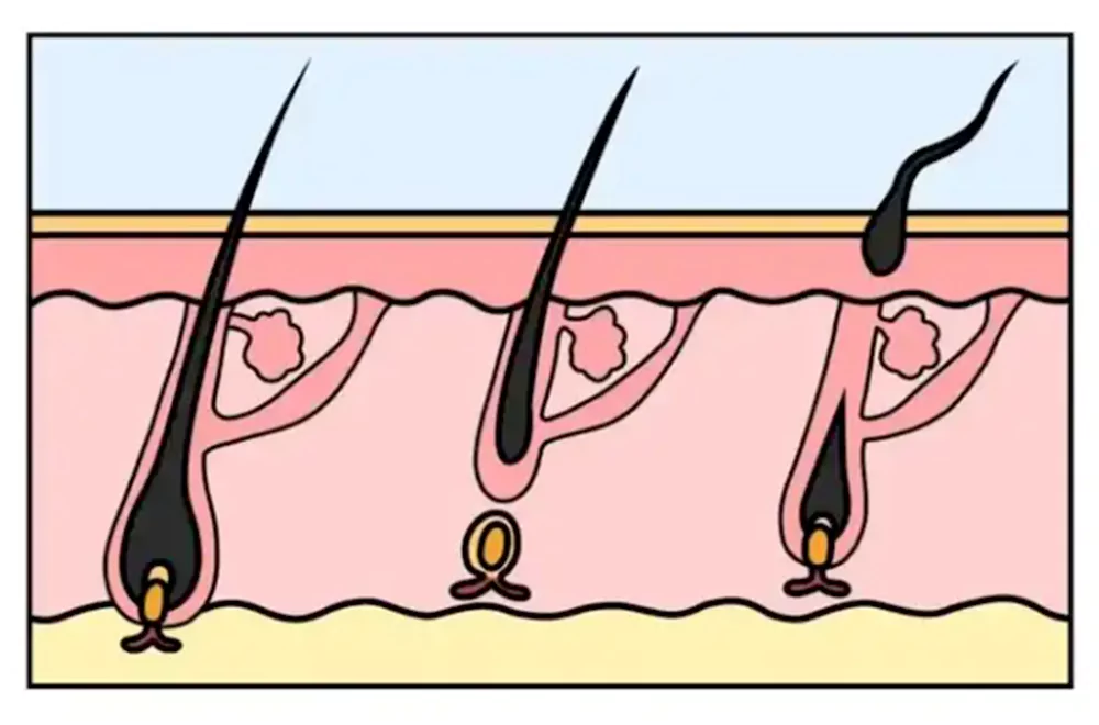 Laser hair removal conditions and relationship with hair growth cycle